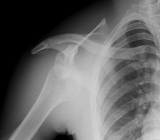 Shoulder X-ray – GP Companion