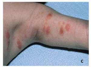 Scabies – GP Companion