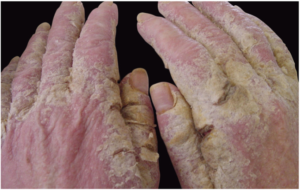 Scabies – GP Companion